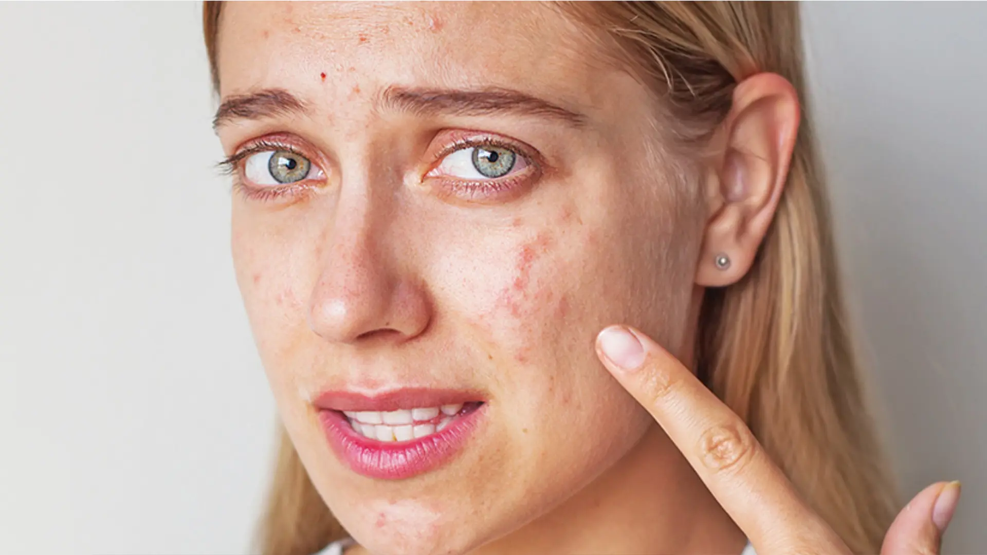 Acneea la femeile adulte - Doctor Fiterman