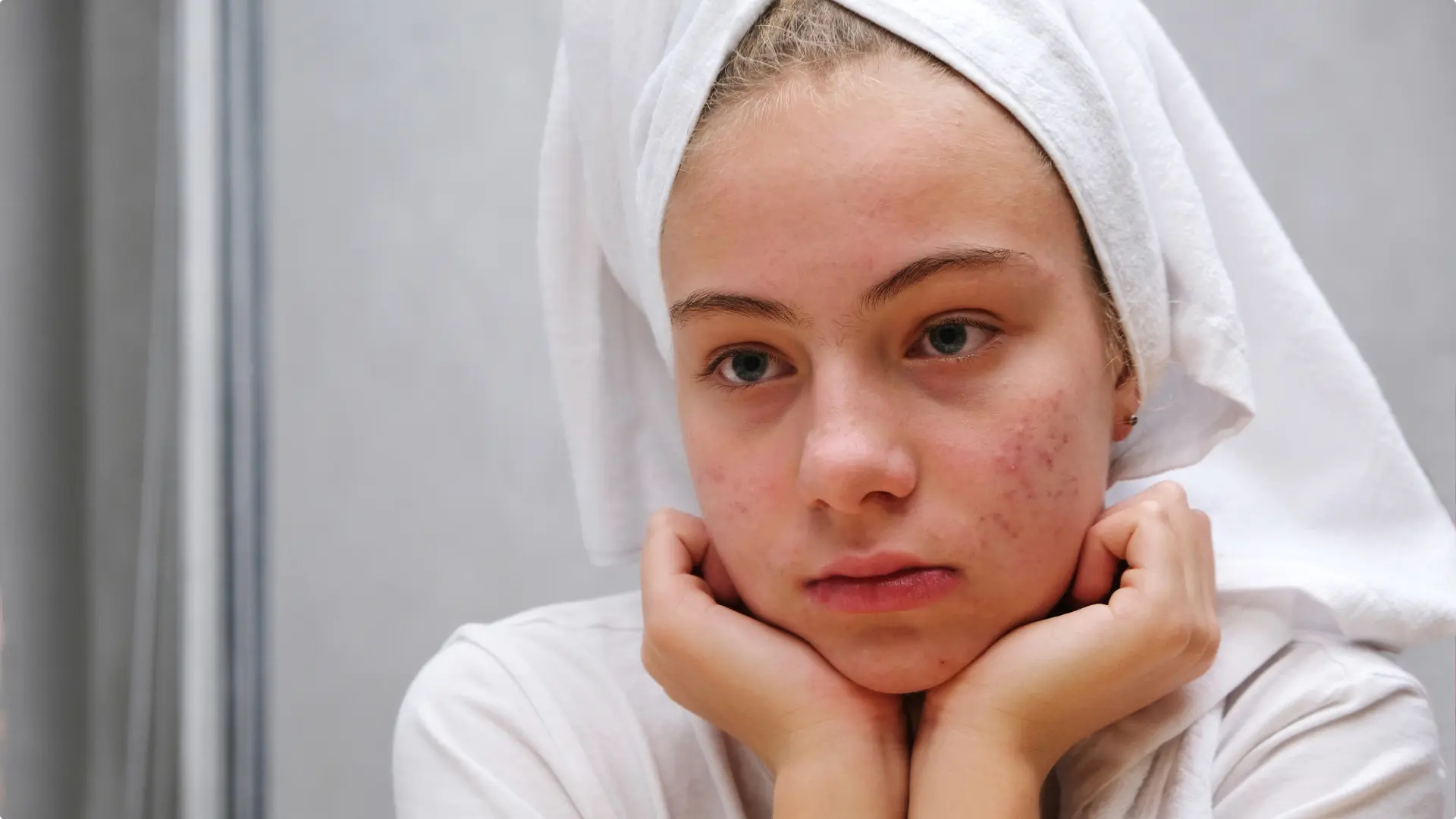 Acneea la adolescenți: cauze și îngrijire - Doctor Fiterman